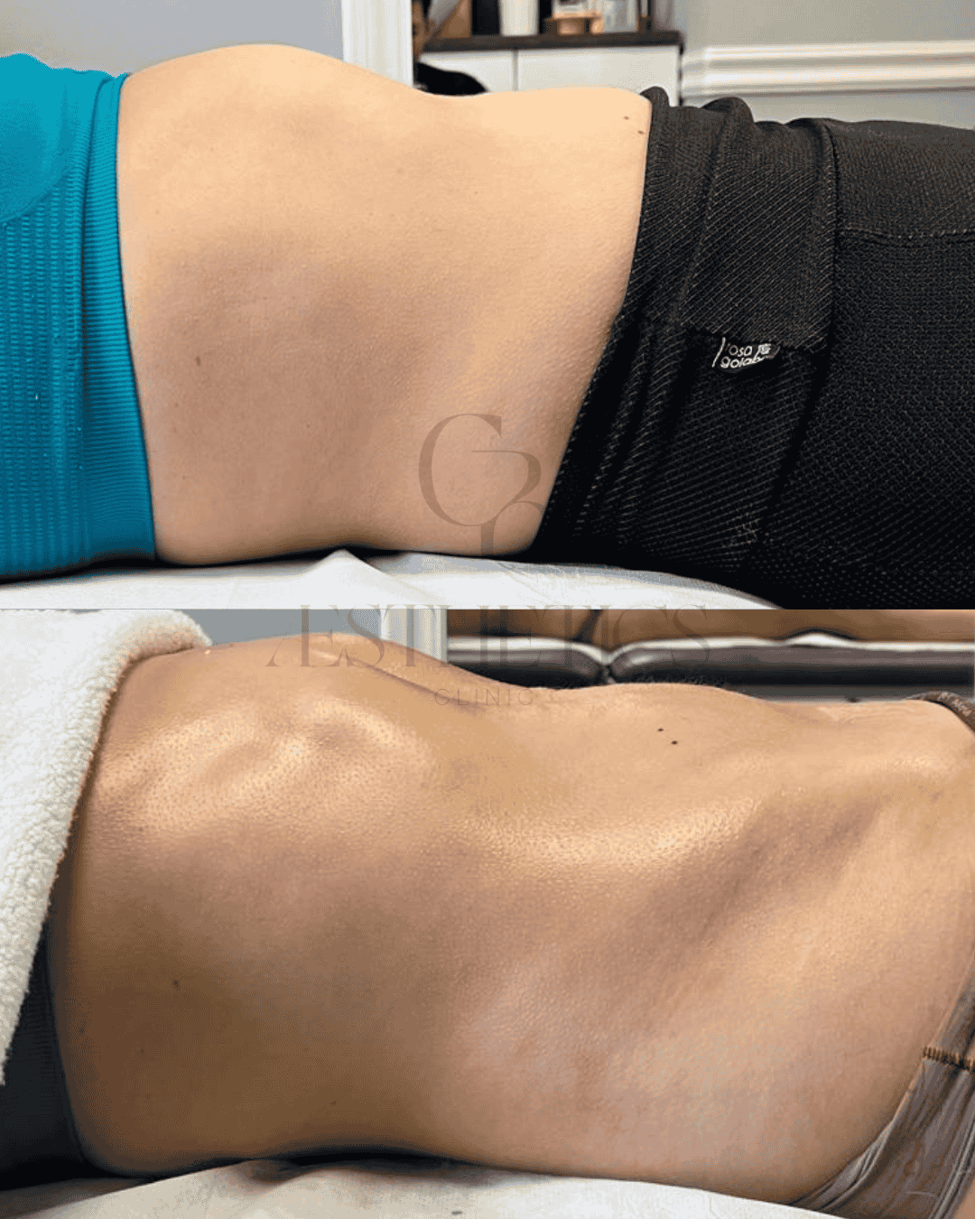 Lymphatic Drainage Massage – GB Aesthetic Clinic